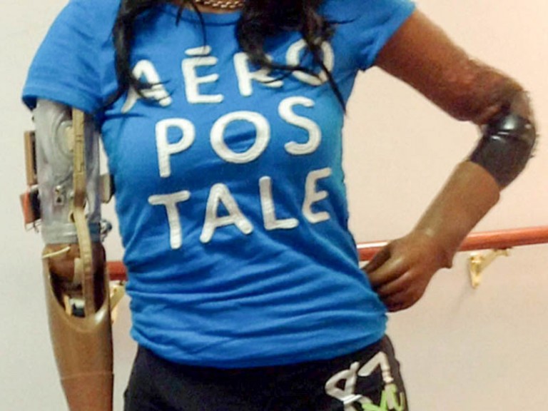 Bilateral Upper Extremity Prosthetics | East Coast Orthotic ...